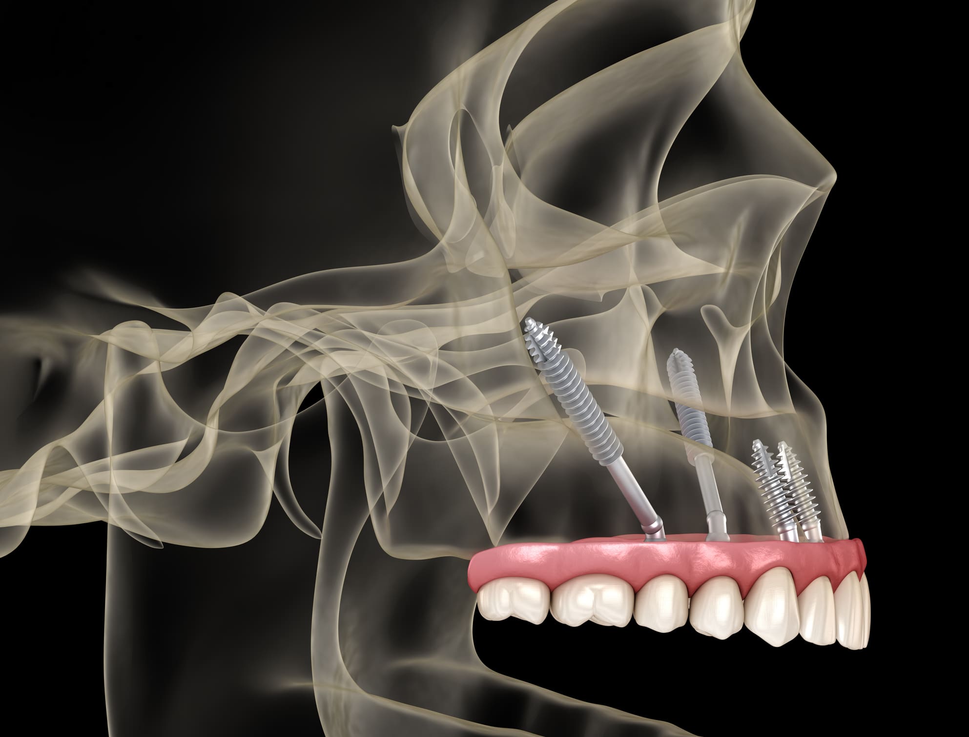 Remote Anchorage Implants in Charleston, WV